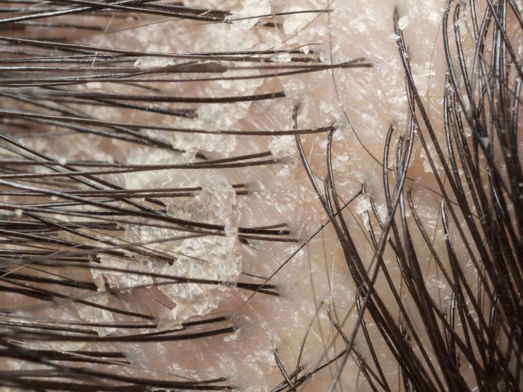 Psoriasis on the scalp: How to manage it and get healthier hair THE EVERY